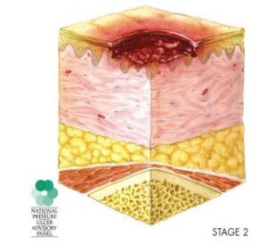 Understanding Bed Sore Injury Claims | Jeff Downey